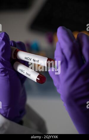 Blood tests for hepatitis B (HBC) and C (HCV Stock Photo - Alamy