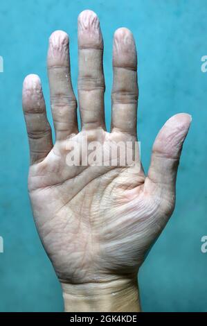 Pruney hand due to long soaking in the water. Hand’s skin shrinking ...