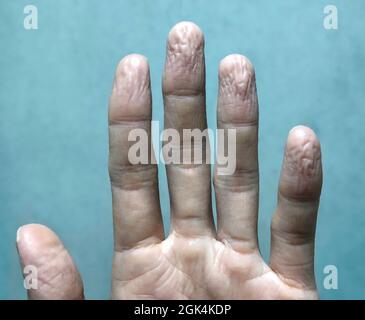 Pruney hand due to long soaking in the water. Hand’s skin shrinking ...