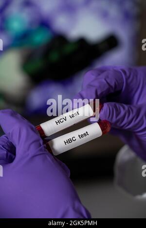 Blood tests for hepatitis B (HBC) and C (HCV Stock Photo - Alamy