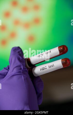 Blood tests for hepatitis B (HBC) and C (HCV Stock Photo - Alamy