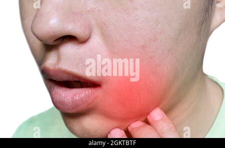 Painful and large cheek or jaw swelling or submental and submandibular ...