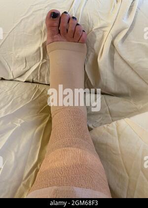 Recovering from vein ablation laser surgery and phlebectomy of the ...