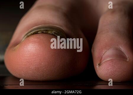 Fungal infection nail matrix. Toenail damage fungal trauma. Bacterial ...