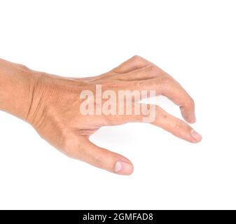 Volkmann’s contracture in upper limb of Asian young man. It is a ...