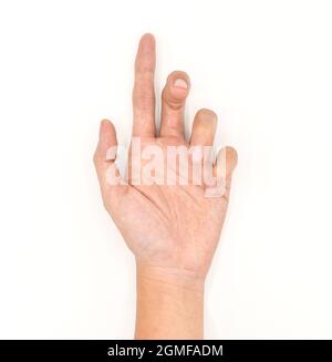 Ulnar claw hand of Asian young woman. also known as 'spinster's claw ...