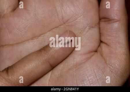 Nevus on finger of Asian young woman. Birthmark Stock Photo - Alamy