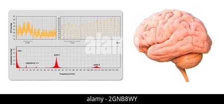 Intracranial Pressure Monitoring ICP waveform, 3d render, 2d graphic ...