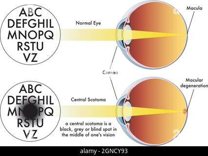 Medical illustration of the symptoms of central scotoma Stock Vector ...