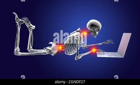 Bad posture whilst using laptop, illustration Stock Photo - Alamy
