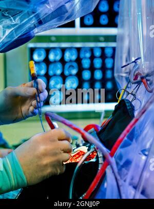 Craniotomy brain surgery. Surgeon using tools to cut open and peel back ...