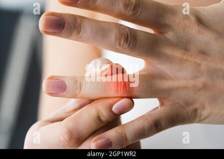 Finger Knuckle Hand Joint Pain And Sprain Stock Photo - Alamy