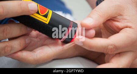 Treatment Laser therapy to the articulation of the thumb Stock Photo ...