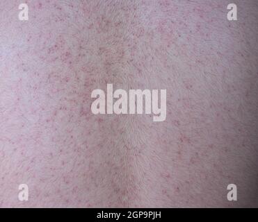 atopic dermatitis symptom skin on hand Stock Photo - Alamy