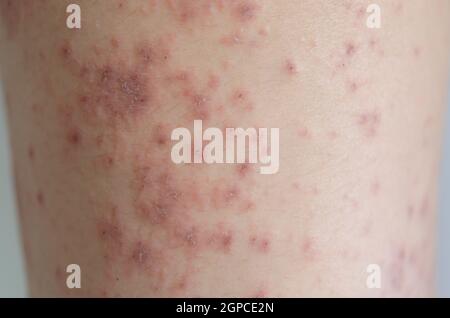 Close-up of skin rashes caused by allergies. Rashes are caused by food ...