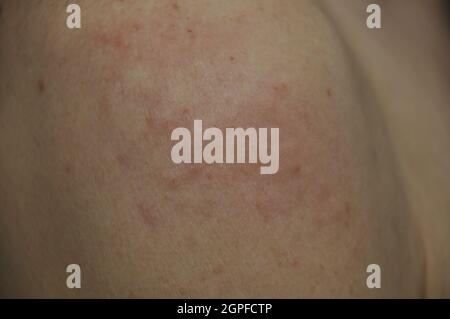 Eczema pimples on a shoulder Stock Photo - Alamy