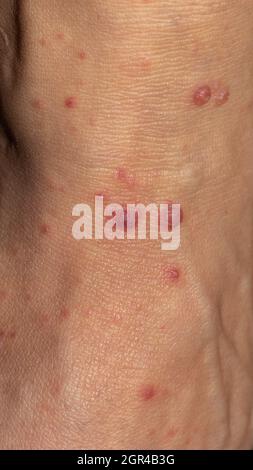 Scarlet fever. Close-up of a rash on the skin of a 15-year-old female ...