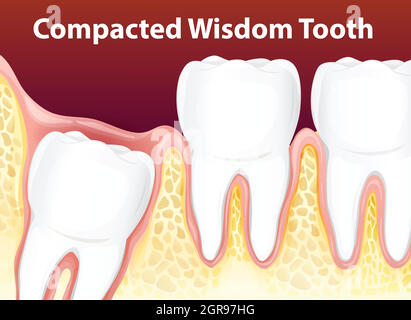 Compacted Wisdom Tooth Diagram Stock Vector Image & Art - Alamy