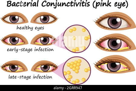 Diagram showing bacterial conjunctivitis in human eye illustration ...
