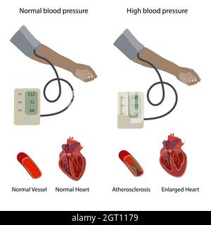 Normal and enlarged heart, illustration Stock Photo - Alamy