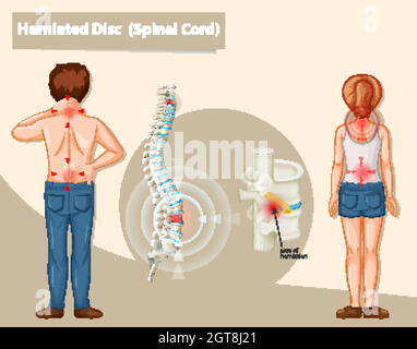 Diagram showing herniated Disc illustration Stock Vector Image & Art ...