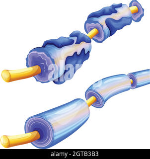 Multiple sclerosis. autoimmune disease. comparison of a healthy neuron ...