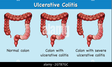 Diagram showing ulcerative colitis illustration Stock Vector Image ...
