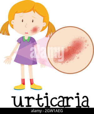 A Vector of Skin Urticaria Stock Vector Image & Art - Alamy