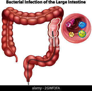 Bacterial Infection of the Large Intestine illustration Stock Vector ...
