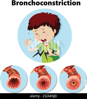 Human Anatomy Bronchoconstriction on White Background illustration ...