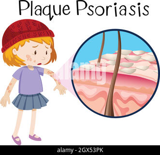 Human Anatomy of Plaque Psoriasis Stock Vector Image & Art - Alamy