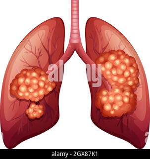 Lung cancer diagram in detail Stock Vector Image & Art - Alamy