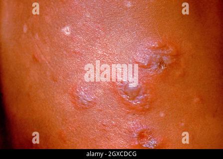 Lepromatous leprosy: type 2 ENL reaction Stock Photo - Alamy
