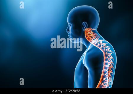 X-ray spinal column with kyphosis posture and pathological vertebrae ...