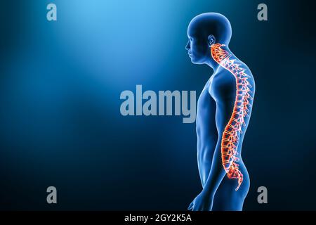 KYPHOSIS, X-RAY Stock Photo - Alamy