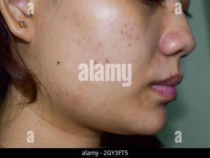 Chloasma or melasma , black spots and acne scars on face of Asian young ...