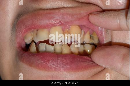 Stacked or overlapping canine teeth of Asian man. Also called crowded ...