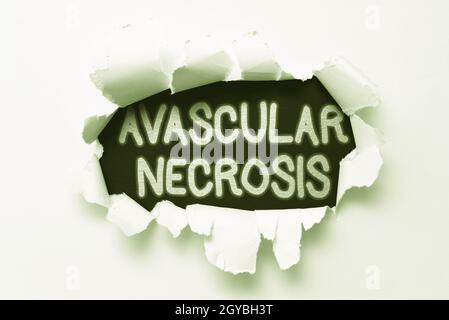 Text sign showing Avascular Necrosis. Business photo showcasing death ...