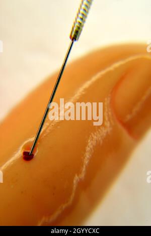 acupuncture demonstration on hand model Stock Photo - Alamy