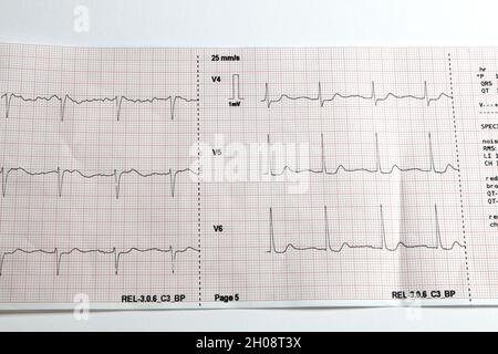 ECG printout from a patient visit, by ambulance first responders Stock ...