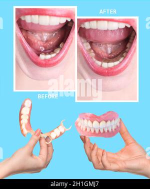 Dental rehabilitation with lower flexible nylon denture, before and ...