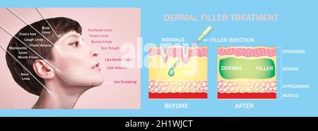 Treatment areas for anti-wrinkle injection. Young female with clean ...