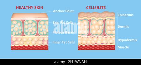 Forming of underskin cellulite illustration. Structure of normal ...
