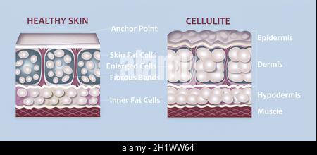 Forming of underskin cellulite illustration. Structure of normal ...