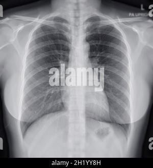 Chest X-ray Of Human Chest or Lung showing normal lung Stock Photo - Alamy