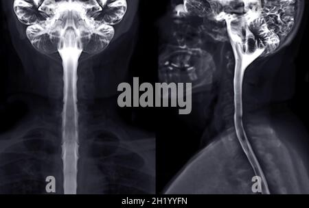 MRI of C-spine or magnetic resonance image of cervical spine Coronal ...