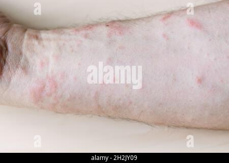 sample of Allergic contact dermatitis - side of male shin with itchy ...