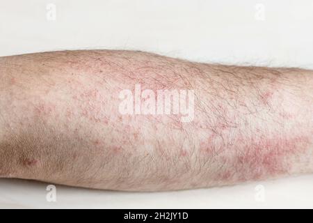 Infected dermatitis. Close-up of infected inflamed skin (dermatitis) on ...