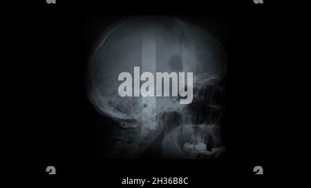 3d illustration - x-ray panels on black background Stock Photo - Alamy