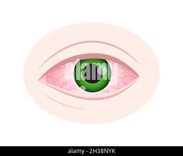 Keratitis eye disease vector illustration Stock Vector Image & Art - Alamy